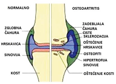 OSTEOARTRITIS - eApoteka